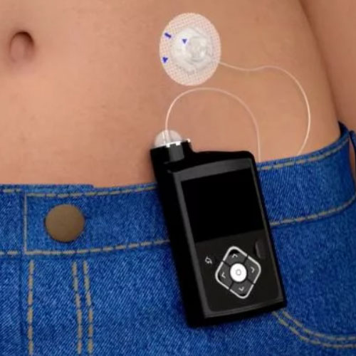 What is Insulin Pump Therapy? | Medtronic Diabetes